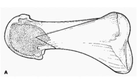 Chapter 29 Offset V Osteotomy Of The 1st Mt Shaft In Hav Flashcards