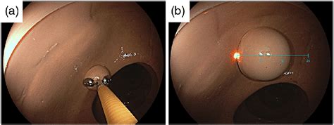 Image Samples For The Polyp Size Estimation Test A Polyp With A Size
