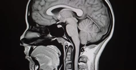 Choroid Plexus The Definitive Guide Biology Dictionary