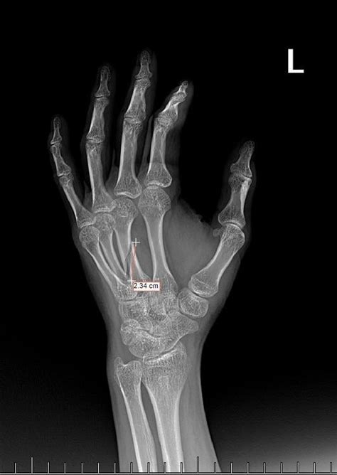 Orif Of 3rd Metacarpal Oblique Fracture D T Falling Down Stairs R Xrays