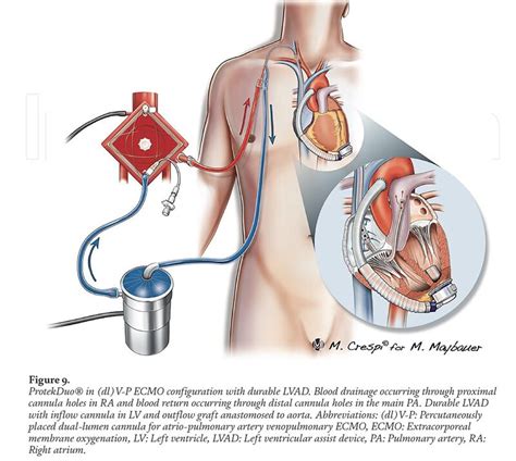Marc O Maybauer On Linkedin Protekduo With Temporary Lvad Propella And Durable Lvad Hm3 Open