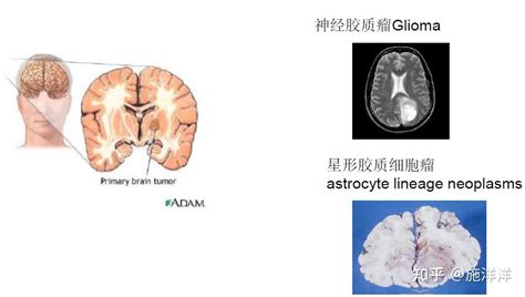神经系统损伤疾病的基本概念和分类 知乎