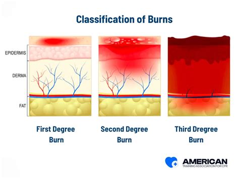 Thermal Burns Causes Symptoms And First Aid Response