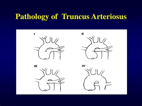 Ppt Truncus Arteriosus Powerpoint Presentation Id597141