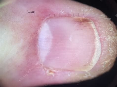 Dermatomyositis Dermoscopy Stock Image C0571893 Science Photo