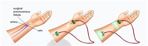 Why You Need An Av Fistula For Dialysis Dr Jathins Vein Center