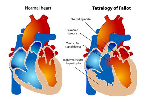 Tetralogia De Fallot Wikipédia A Enciclopédia Livre