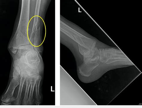 Pre Reduction Anterior Posterior And Lateral X Ray Views Demonstrating