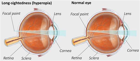 How To Improve Long Sightedness Crazyscreen21