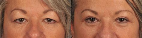What Are The Best Nonsurgical Alternatives To Eyelid Surger Dr