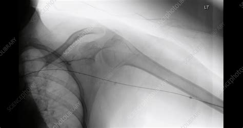 Balloon Treatment And Stent For Blocked Artery Angiogram Stock Image F0436349 Science