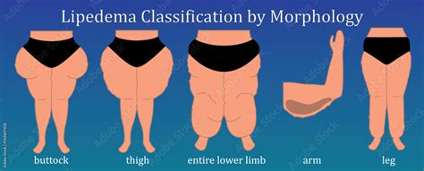 Lipedema Classification By Morphology Obesity Types Stock Vector