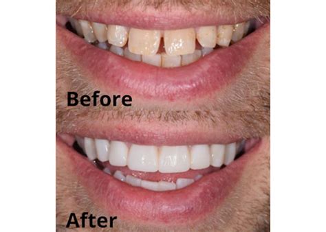 A Look At Teeth Bonding Before And After