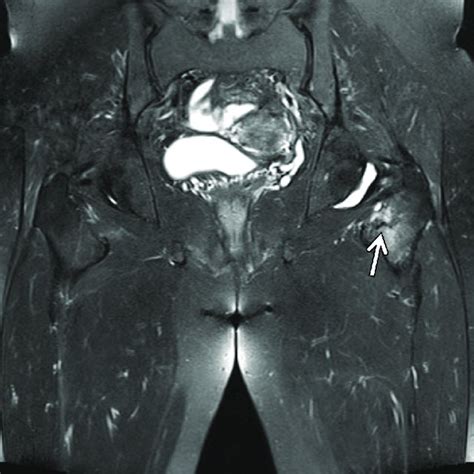 Stress Fracture Coronal Fat Suppressed T2 Weighted Image Of A
