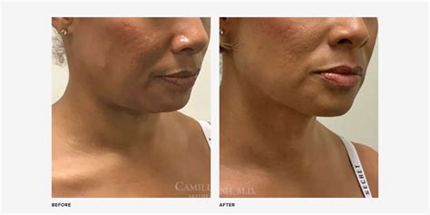 The Best Morpheus8 Before And After Photos Realself News