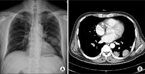 A Nodular Opacity Was Noted In Left Lower Lung At The Time Of Download Scientific Diagram