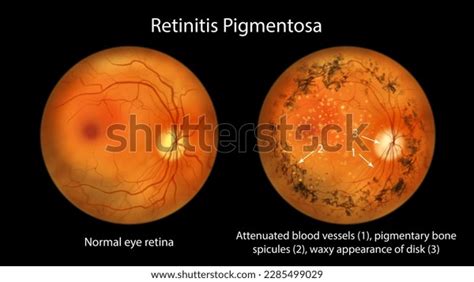 Retinitis Pigmentosa Genetic Eye Disease Illustration Stock