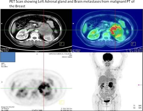 Metastatic Malignant Phyllodes Tumor Of The Breast An Aggressive