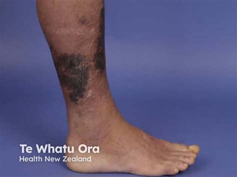 Fascitis Necrosante Understanding Limb Necrotizing Infections A