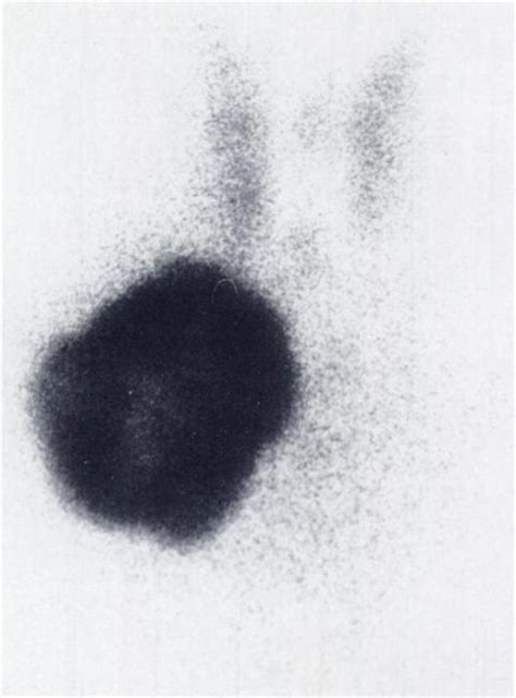 Figure4 Technetium 99m Pertechnetate Thyroid Scan Shows Avid Uptakeby