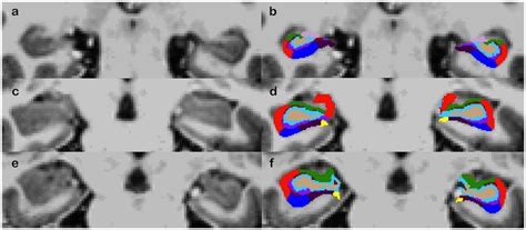 Hippocampal Subfields Segmentation Note Hippocampal Subfield