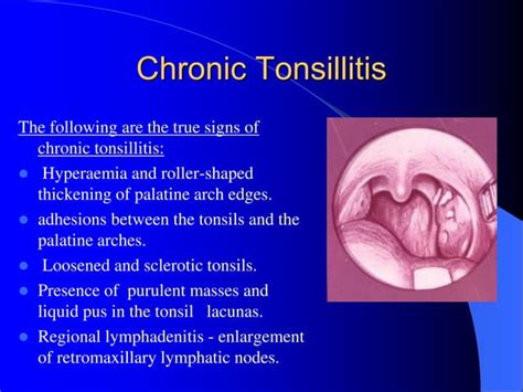 L6tonsillitis Adenoids Tonsillar Hypertrophy Lecturepdf
