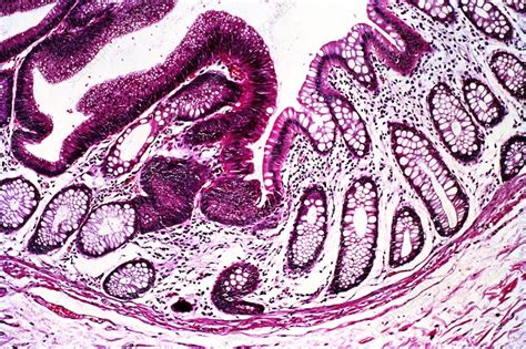 Diverticular Disease Light Micrograph Stock Image C0030255