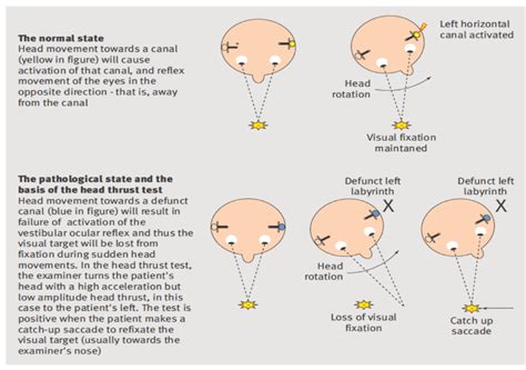 Cme 160114 Vestibular And Vertigo Assessment Charlies Ed