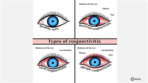 Conjunctivitis Its Types Clinical Manifestation And Nursing Management Pptx