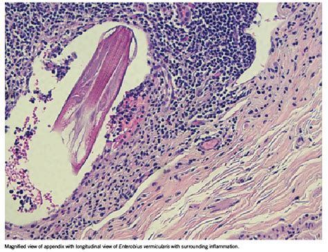 An Unusual Etiology Of Appendicitis A Girl With Appendicitis And