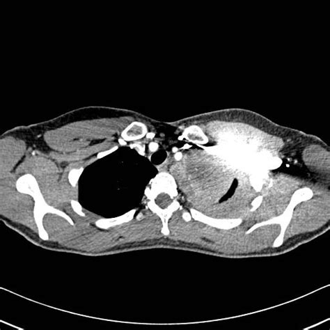 Radiopaedia Case Synovial Cell Sarcoma Id 20011 Study 20046 Nc Commons