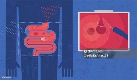 Colonoscopy Detecting Colon Abnormalities And Removing Polyp High Res Vector Graphic Getty Images