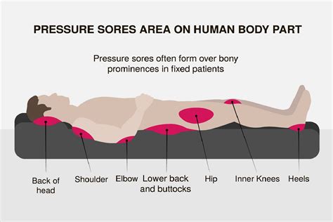 Wockhardt Education Initiative How Pressure Ulcers Bed Sore Kills