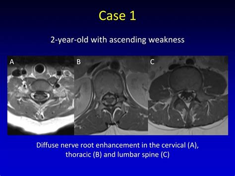 Ppt Pediatric Nerve Root Enhancement Review Powerpoint Presentation
