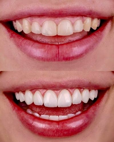 Crown Lengthening In Daly City Gummy Smile Treatment