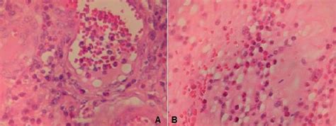 Eosinophilic Gastroenteritis In Basset Hound Dog