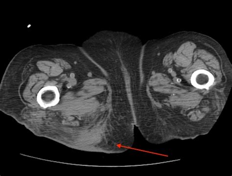The Ins And Outs Of Inflammation Neighborhood Radiologist