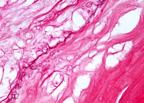 Occlusive Atherosclerosis At 40x Magnification Nikons Microscopyu