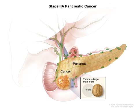 Pancreatic Cancer Treatment Pdq® Nci