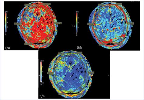 Ct Perfusion A Сbf B Cbv C Mtt 3 Days After Surgery Perfusion Download Scientific