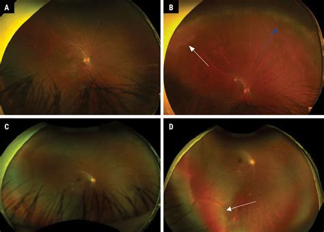 Ultra Widefield Imaging Detects 83 Of Peripheral Retinal Breaks
