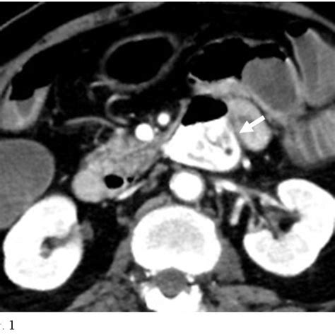 Pdf Arterial Supply To The Bleeding Diverticulum In The Ascending Duodenum Treated By