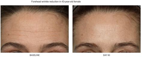 Nuface Trinity Facial Toning Device Kit