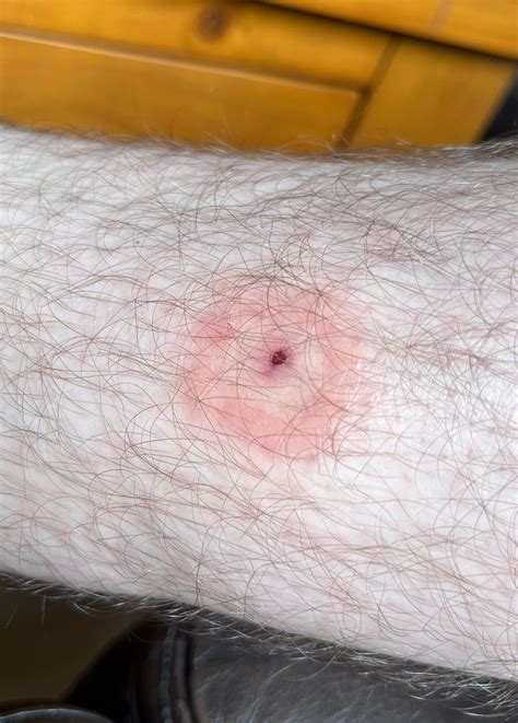 Could These Be Tick Bites Rlyme