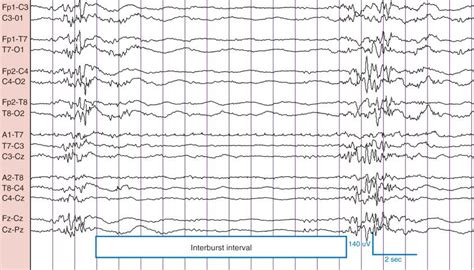 The Normal Eeg From Neonates To Adolescents Clinical Tree