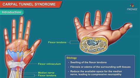 Median Nerve Carpal Tunnel