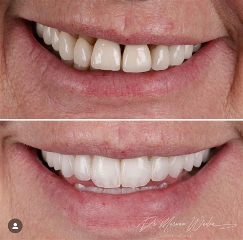 Denture Is A Smile Makeover — Clean Teeth Dental