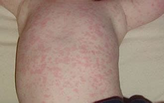 Erythema Infectiosum Rcemlearning