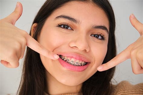 Braces Traditional Orthodontics At Acevedo Dental Group Montebello