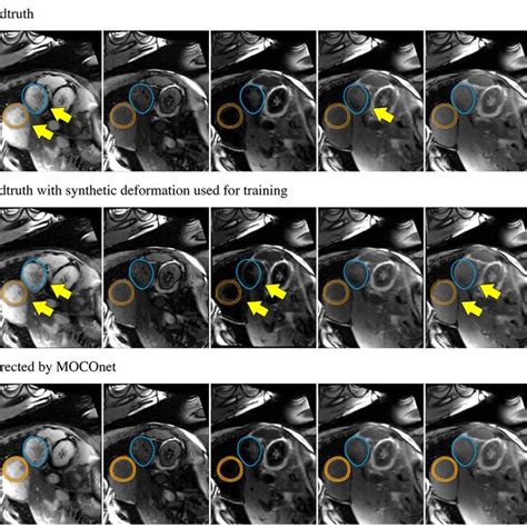 Robustness Of The Proposed Motion Correction Convolutional Neural Download Scientific Diagram